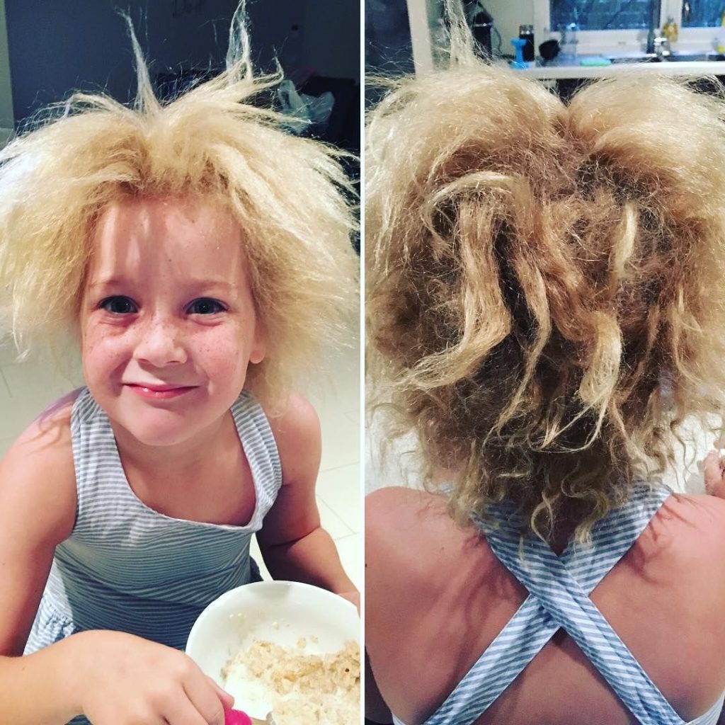 Síndrome de Menkes: 6 formas de detectarlo